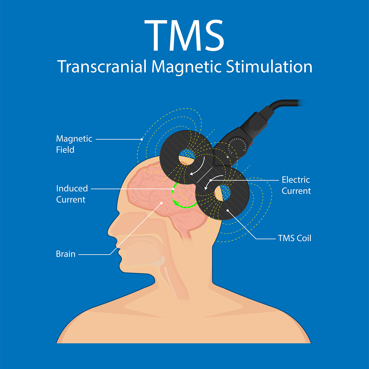 Pros Cons Of TMS TMS Center At Southeastern Psychiatric Associates Pros Cons Of TMS TMS Center At Southeastern Psychiatric Associates